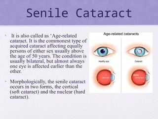cataract.pptkhggjjyfyfyfyjfyyjfjygggguyg | PPT