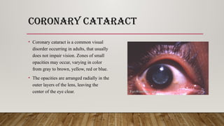 Anatomy of human eye ,cataract and its treatment | PPTX