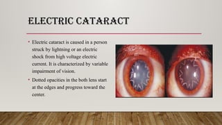 Anatomy of human eye ,cataract and its treatment | PPT
