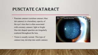 Anatomy of human eye ,cataract and its treatment | PPT