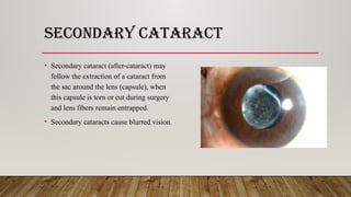 Anatomy of human eye ,cataract and its treatment | PPTX