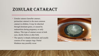 Anatomy of human eye ,cataract and its treatment | PPT