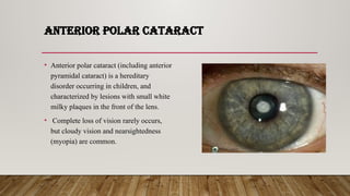 Anatomy of human eye ,cataract and its treatment | PPTX