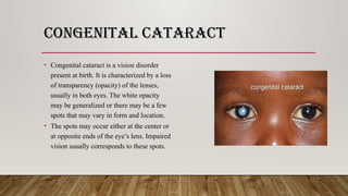 Anatomy of human eye ,cataract and its treatment | PPTX