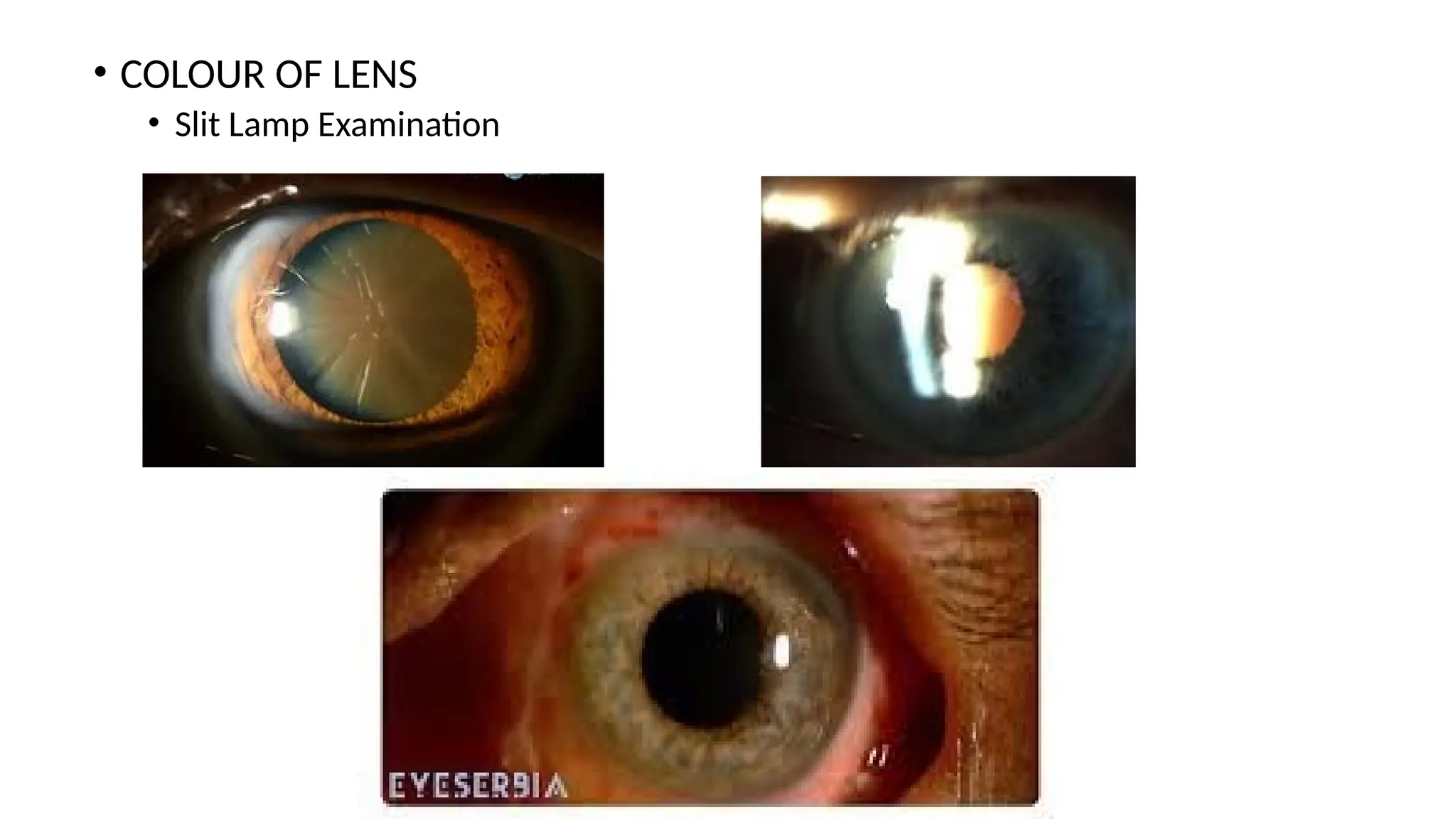 CATARACT types classification how it forms | PPTX