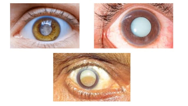 CATARACT types classification how it forms | PPTX