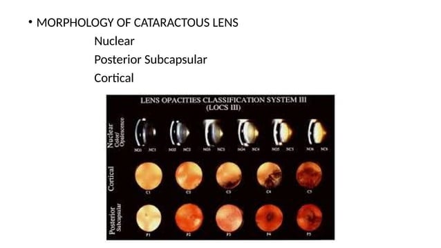 CATARACT types classification how it forms | PPTX