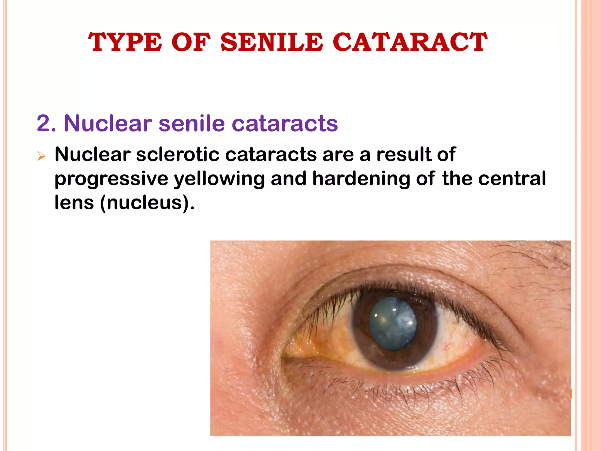 Cataract | PDF