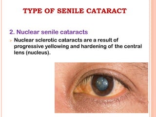 Cataract | PDF
