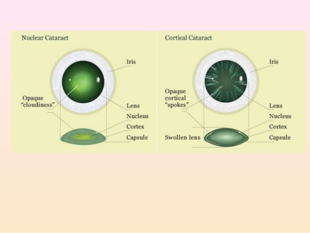 CATARACT DISEASE.