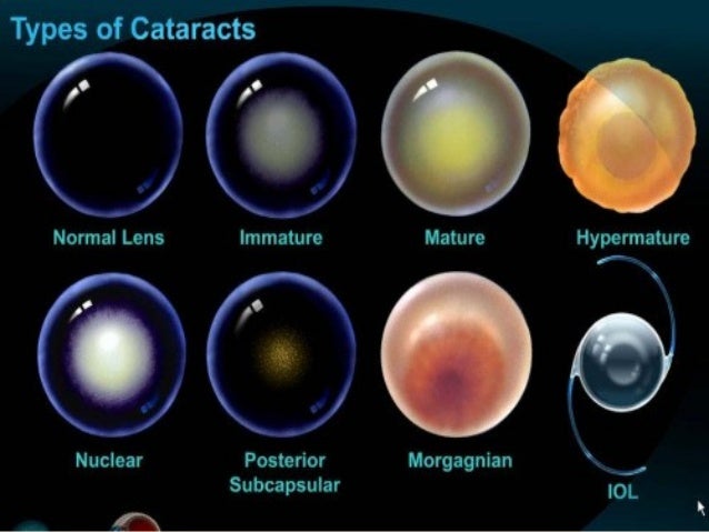 Cataract Disease