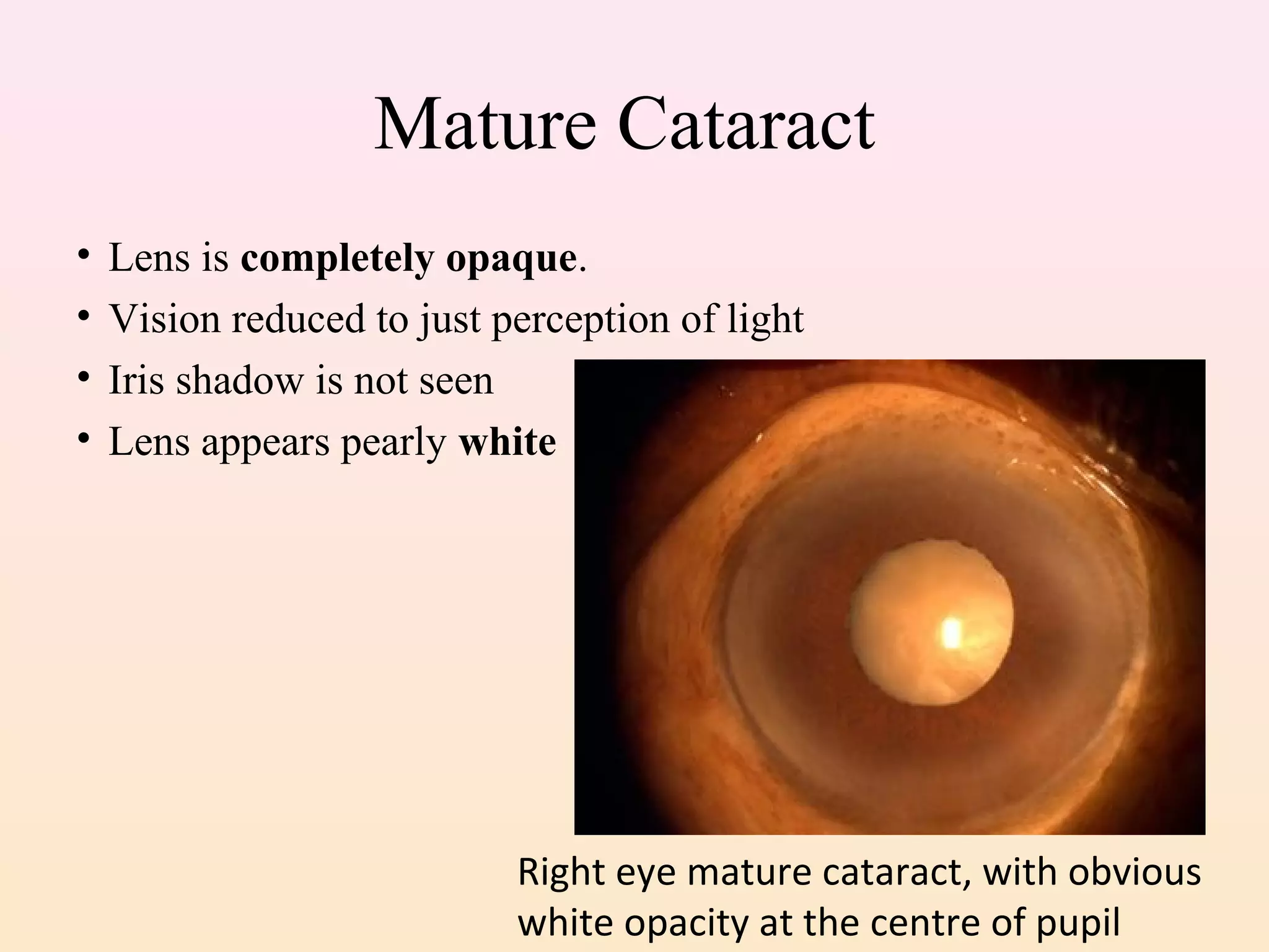 Cataract | PPT