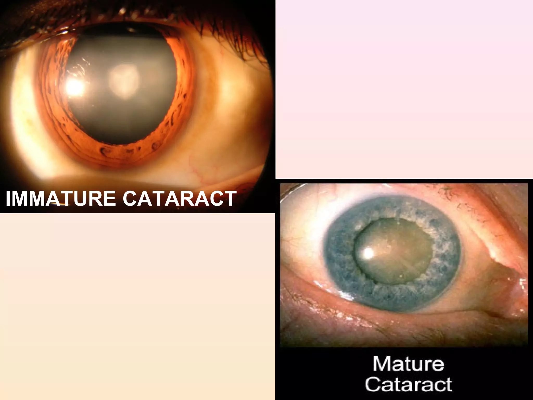 Cataract | PPT