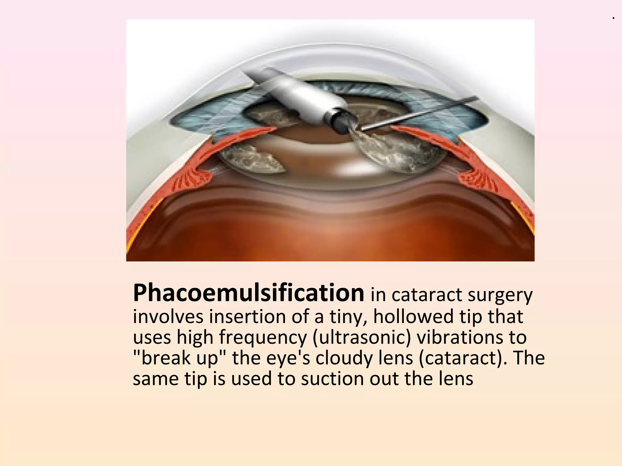 Cataract | PPT