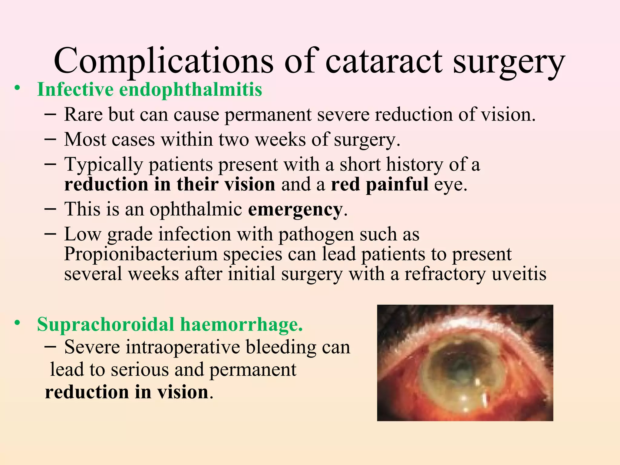 Cataract | PPT