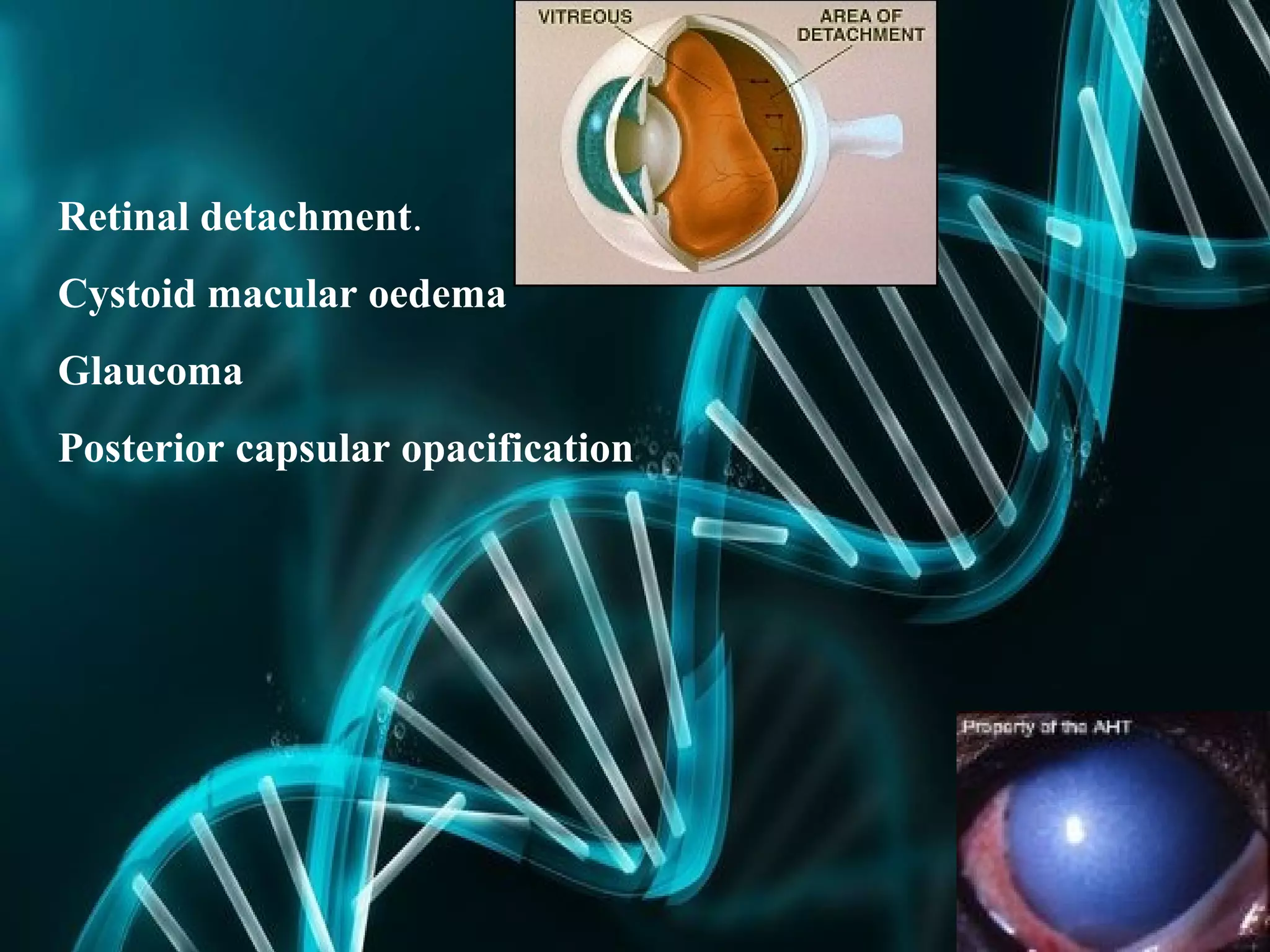 Cataract | PPT