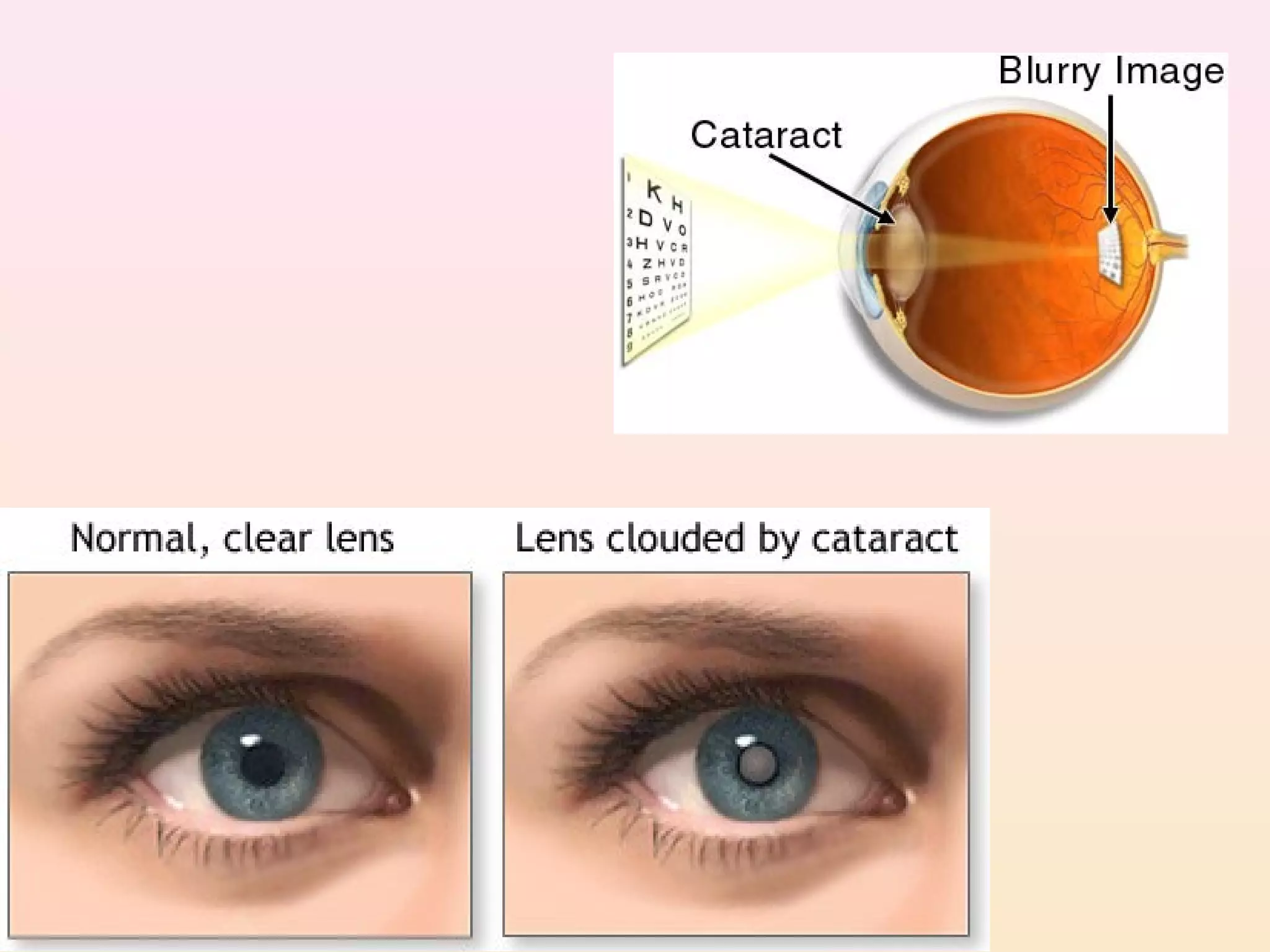 Cataract | PPT