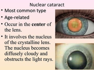 Cataract | PPT