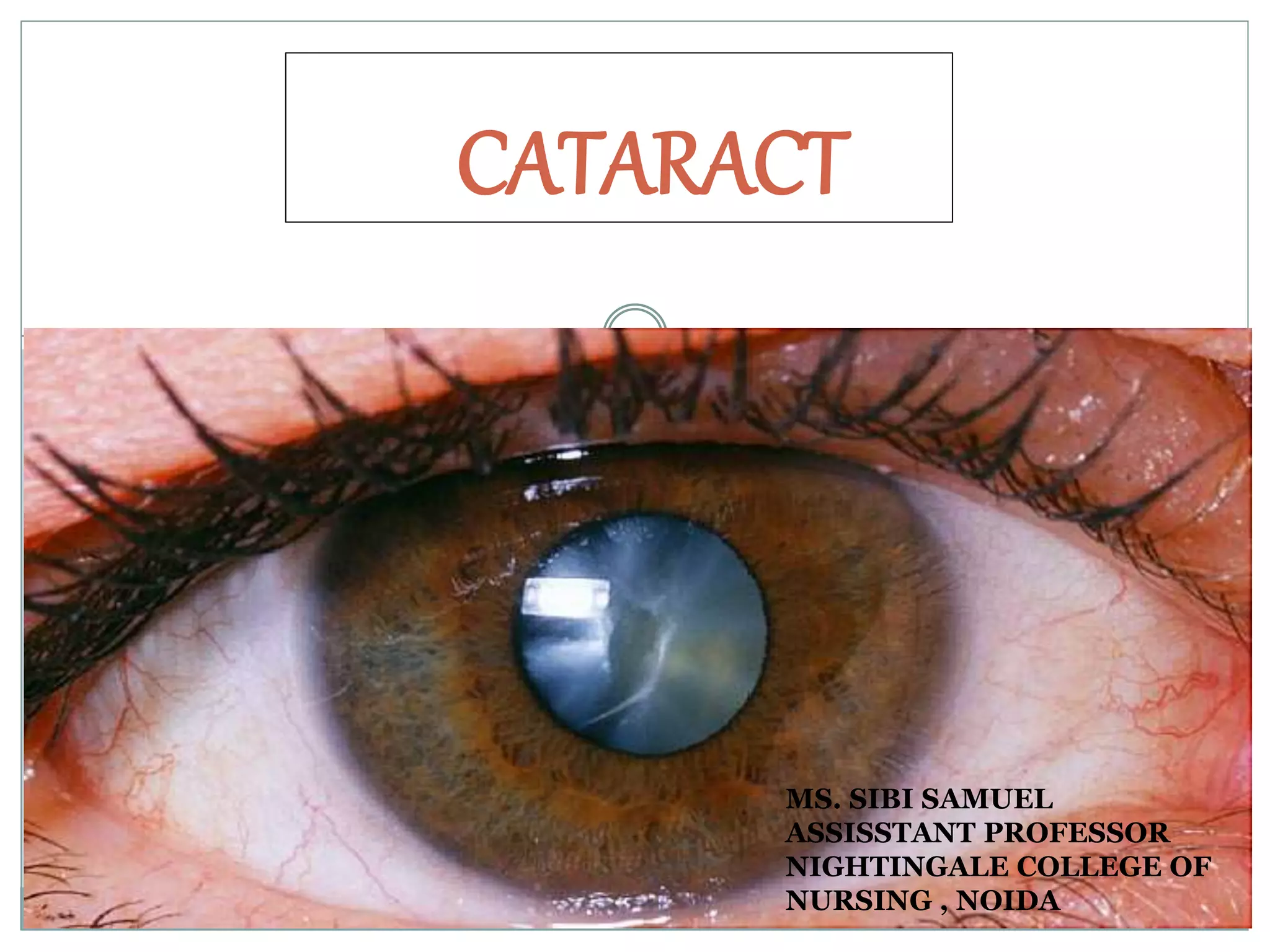 Cataract-Ppt.pptx | Eye and Vision Conditions | Diseases and Conditions