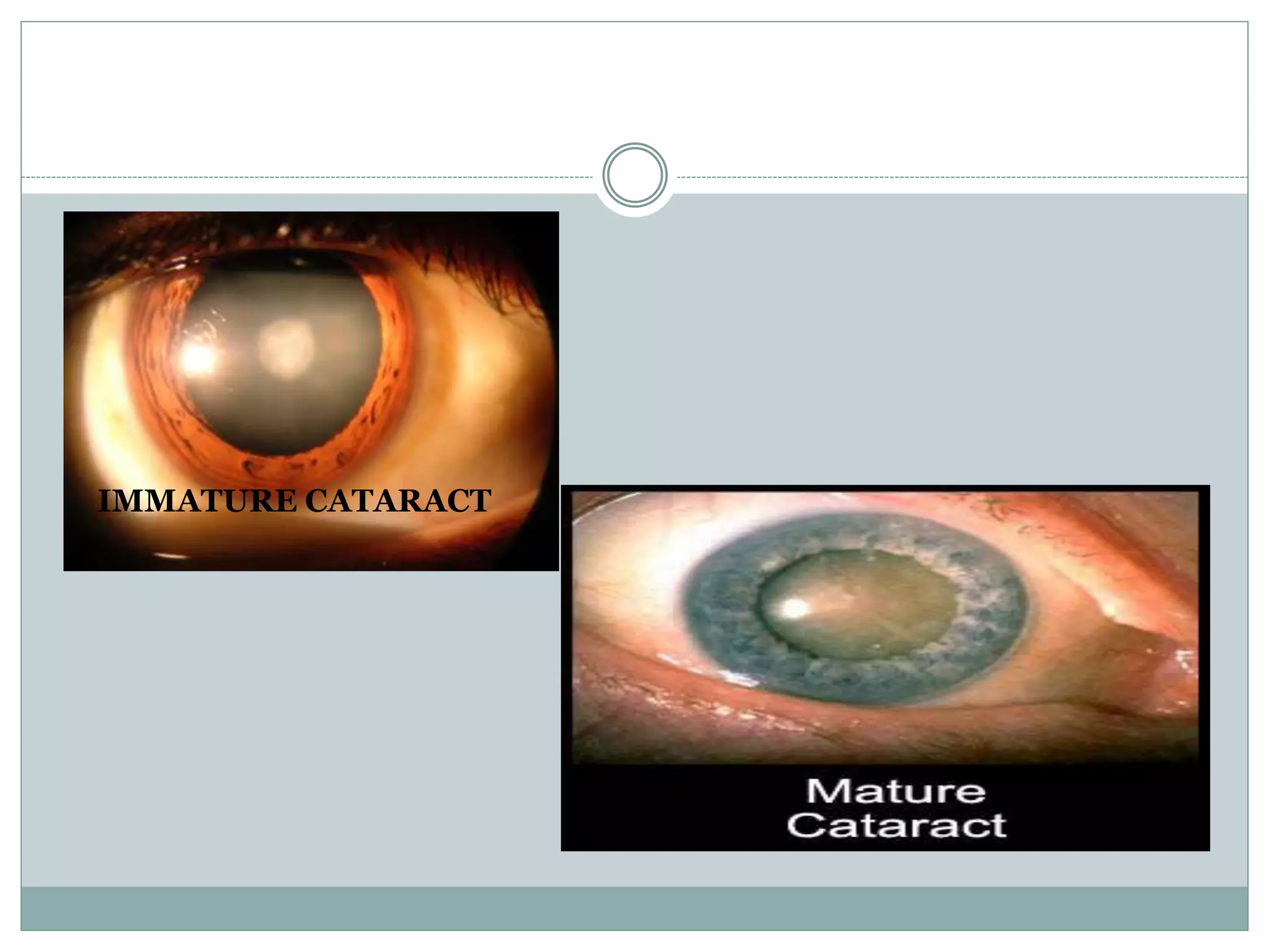Cataract-Ppt.pptx