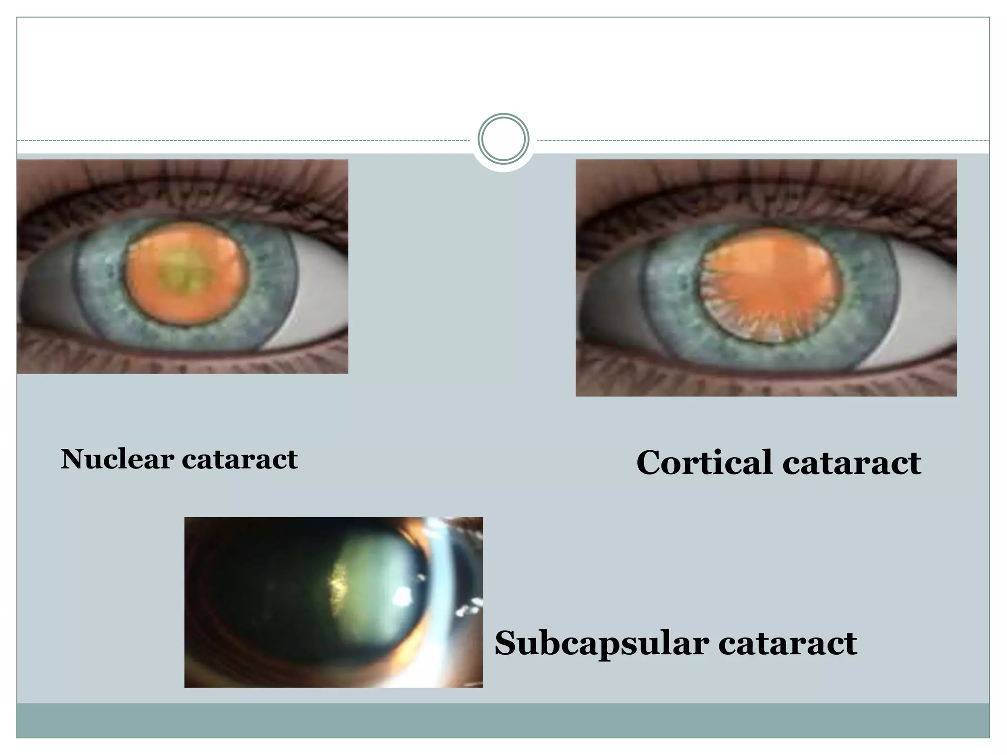 Cataract-Ppt.pptx
