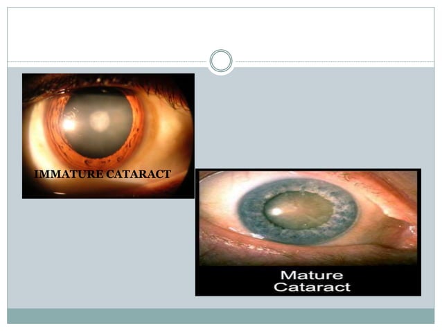 Cataract-Ppt.pptx | Eye and Vision Conditions | Diseases and Conditions