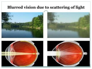 Cataract-Ppt.pptx