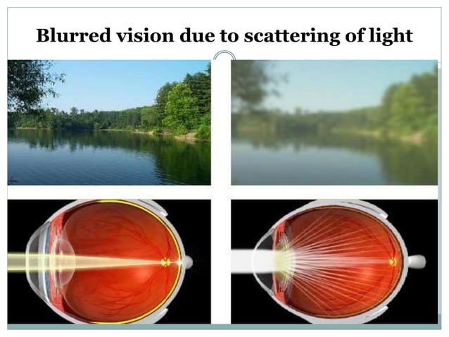 Cataract-Ppt.pptx | Eye and Vision Conditions | Diseases and Conditions