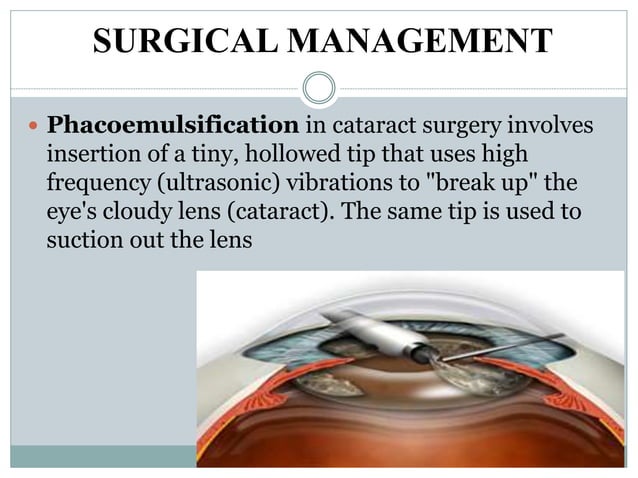 Cataract-Ppt.pptx | Eye and Vision Conditions | Diseases and Conditions