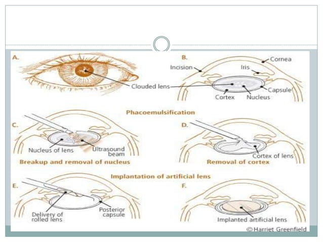 Cataract-Ppt.pptx | Eye and Vision Conditions | Diseases and Conditions