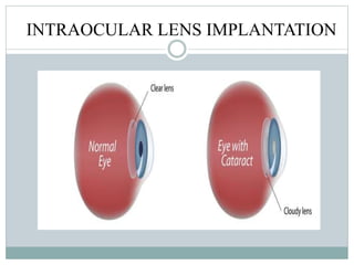 Cataract-Ppt.pptx