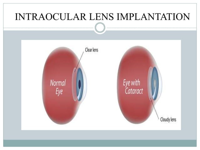Cataract-Ppt.pptx | Eye and Vision Conditions | Diseases and Conditions