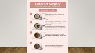 CATARACT-SURGERY.pdf | Eye and Vision Conditions | Diseases and Conditions