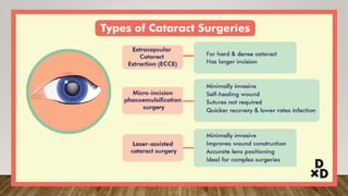 CATARACT-SURGERY.pdf