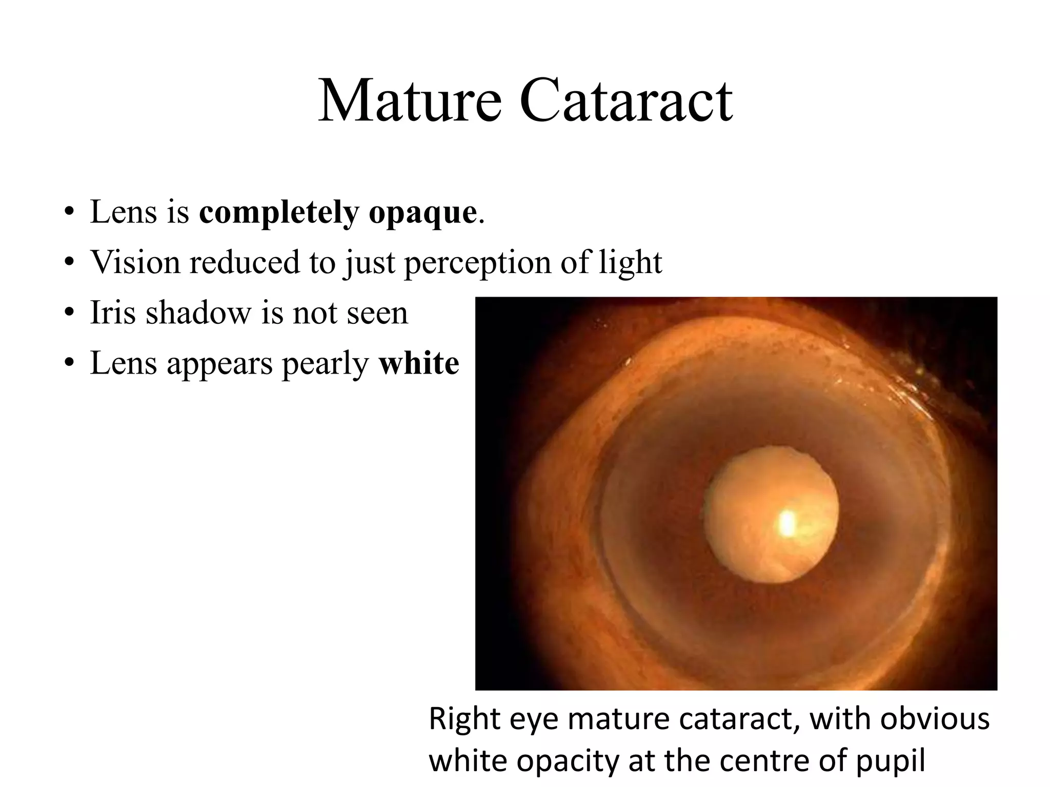 Cataract_0.ppt