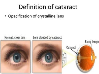 Cataract_0.ppt