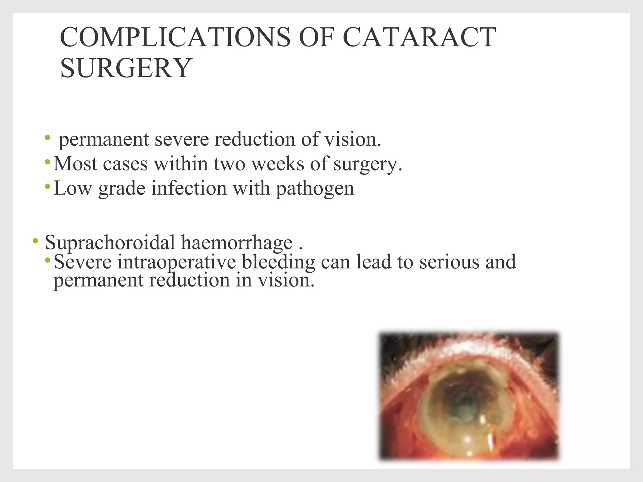 Cataract | PPT