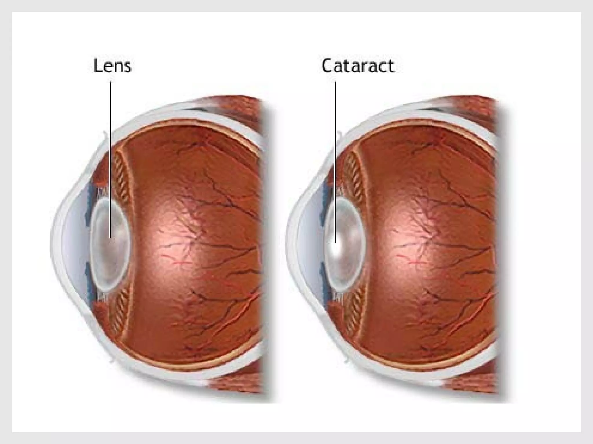 Cataract | PPT