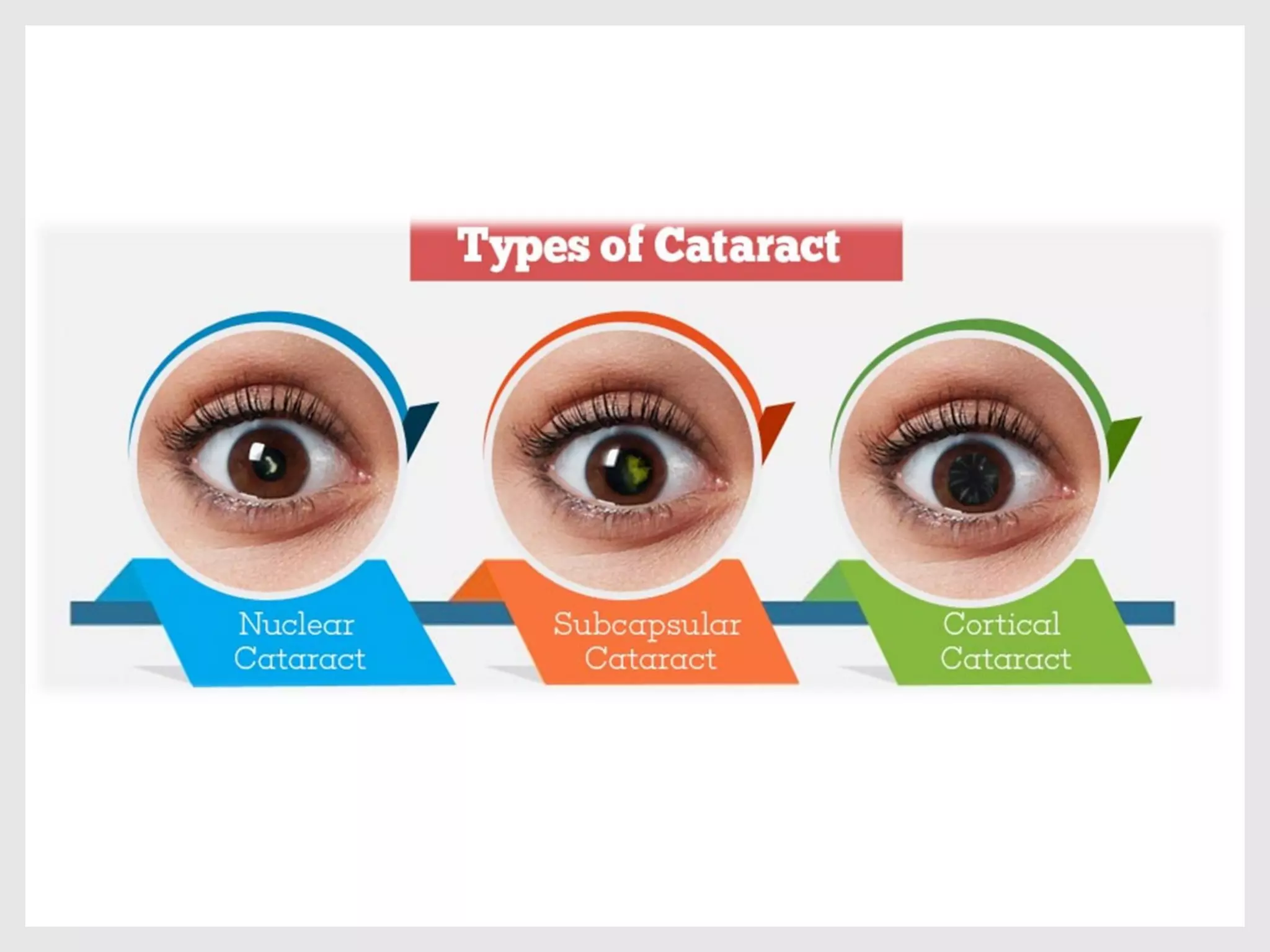 Cataract | PPT