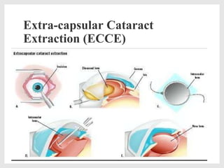 Cataract | PPT
