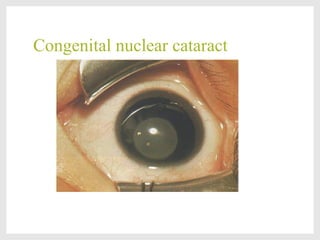 Cataract | PPT