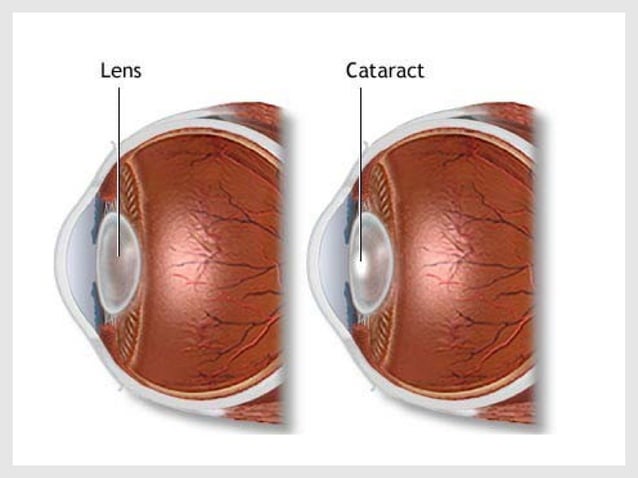 Cataract | PPT
