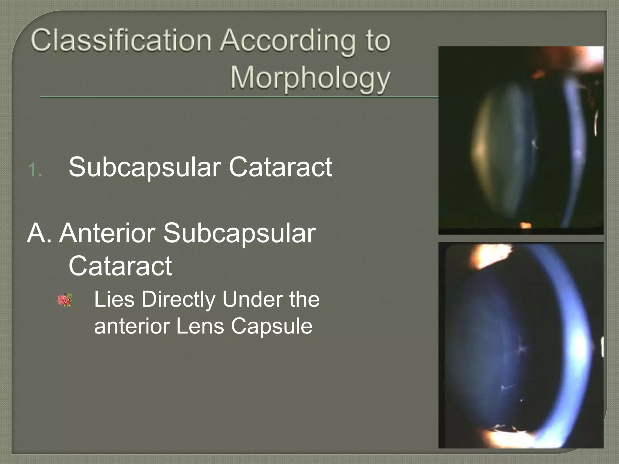 CATARACT 1.pptx