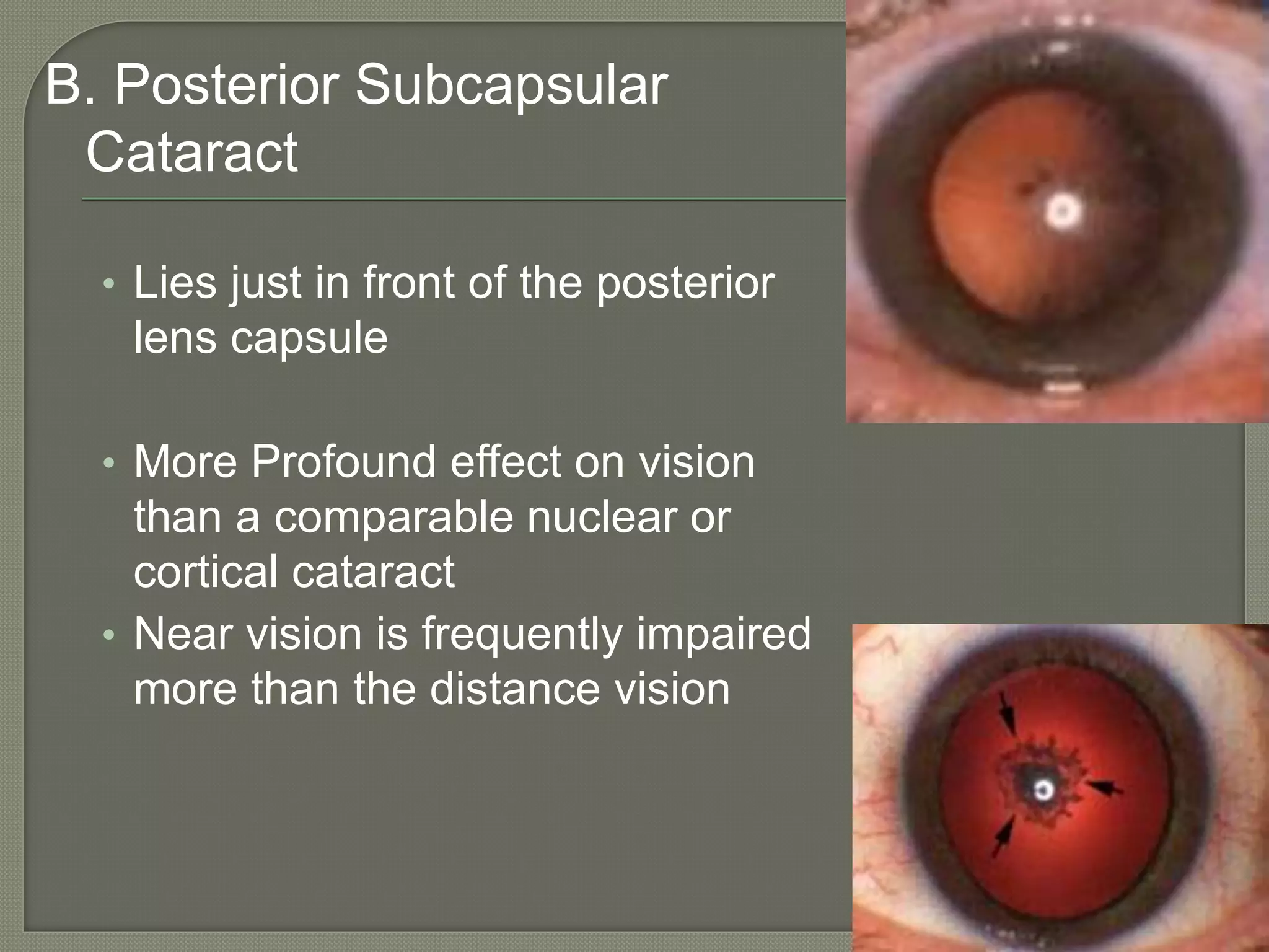 CATARACT 1.pptx