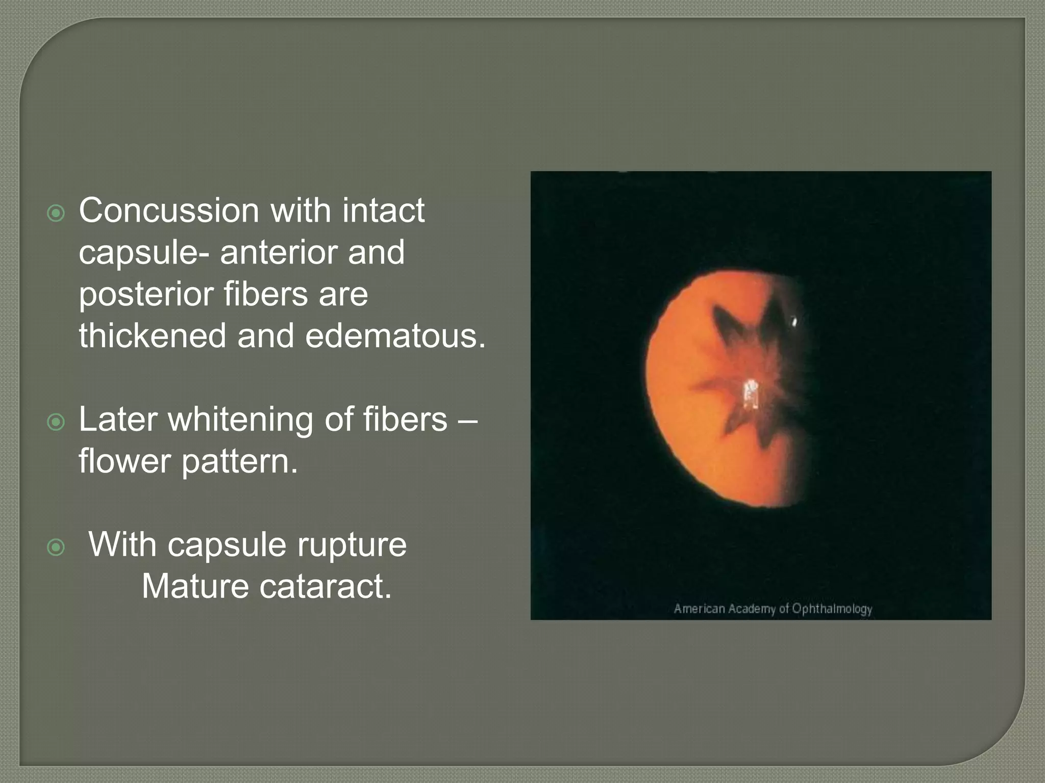 CATARACT 2.pptx