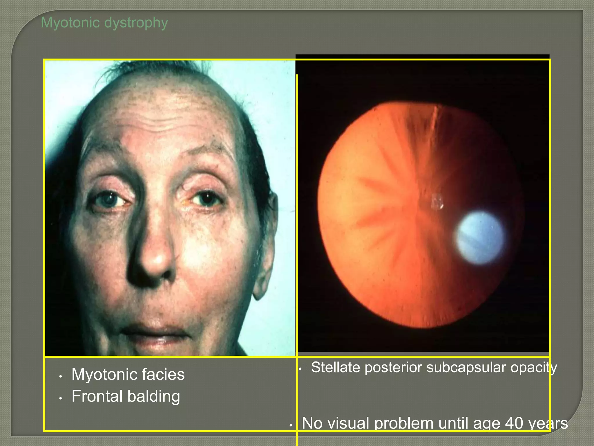 CATARACT 2.pptx