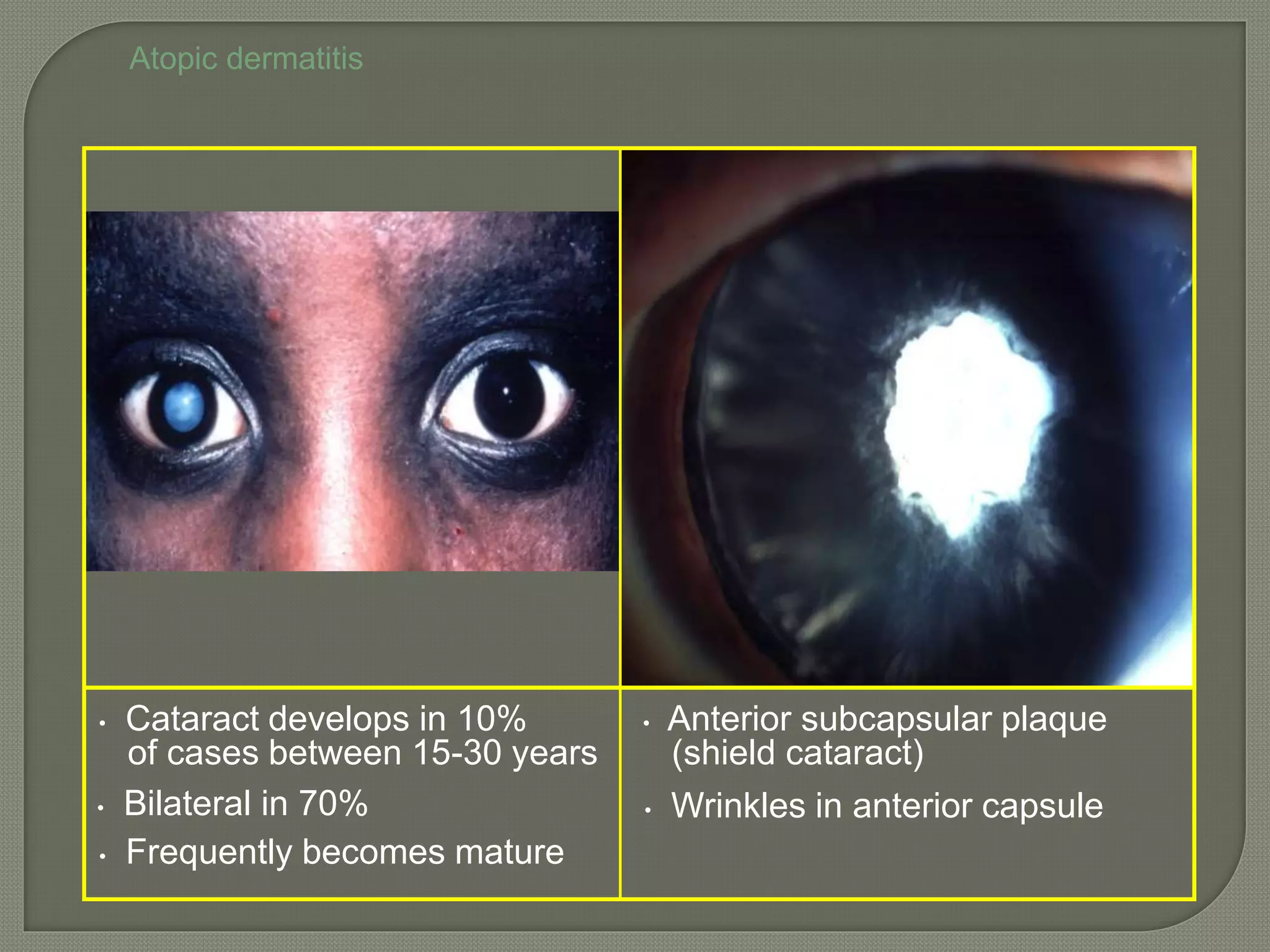 CATARACT 2.pptx