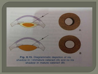 CATARACT 2.pptx