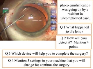 Cataract=4 phaco | PPTX