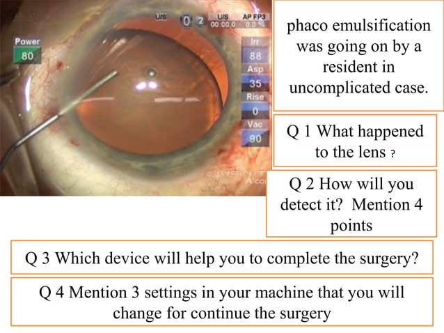 Cataract=4 phaco | PPT